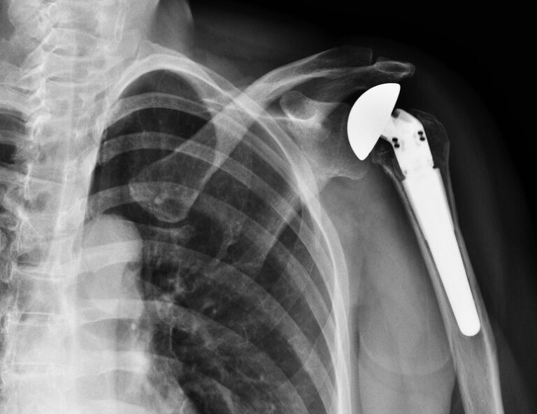 Best Shoulder Hemiarthroplasty Surgeon Delhi | Dr. Biren Nadkarni